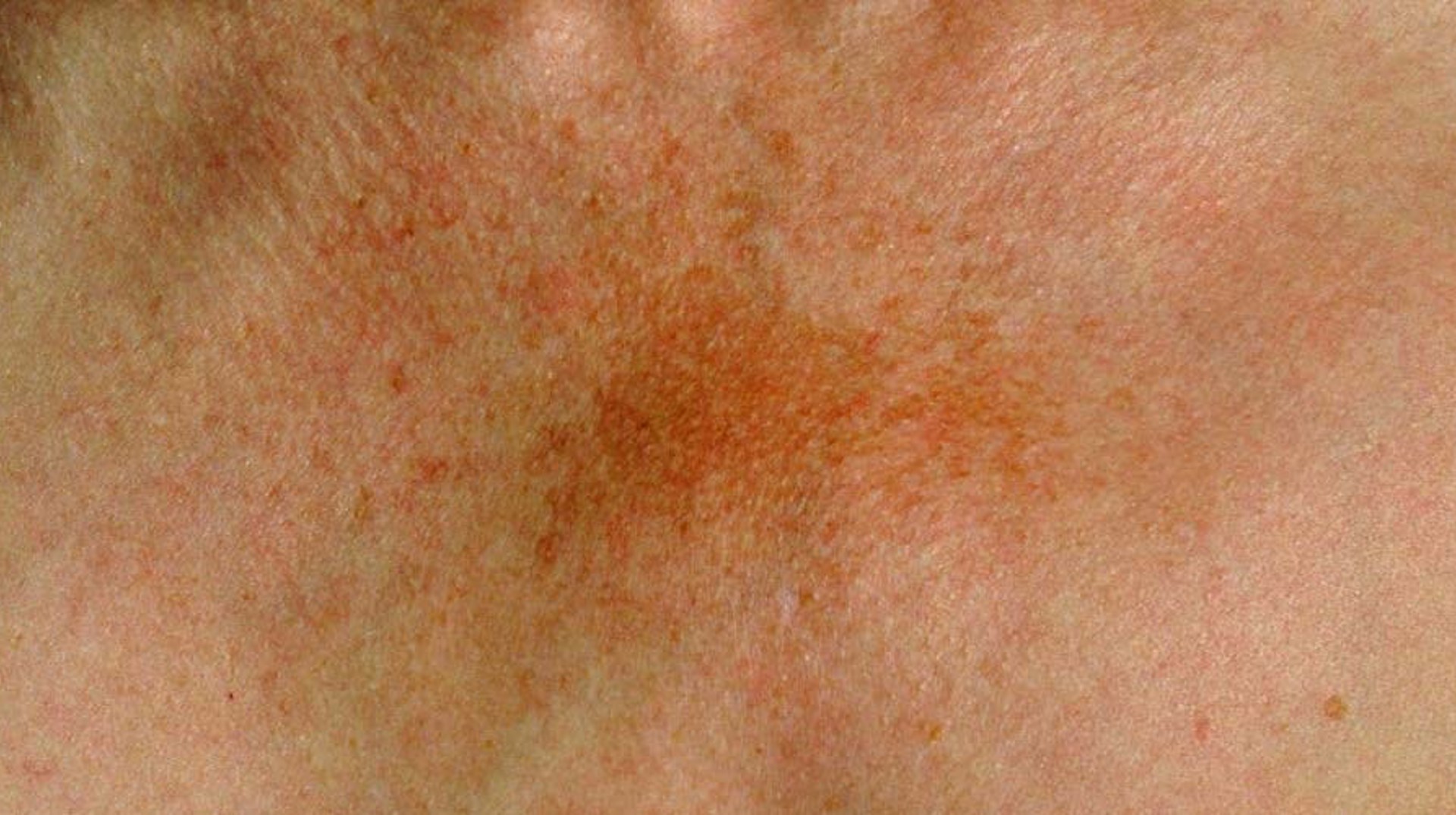 Fjerne tatovering - tatoveringsfjerning | Aleris